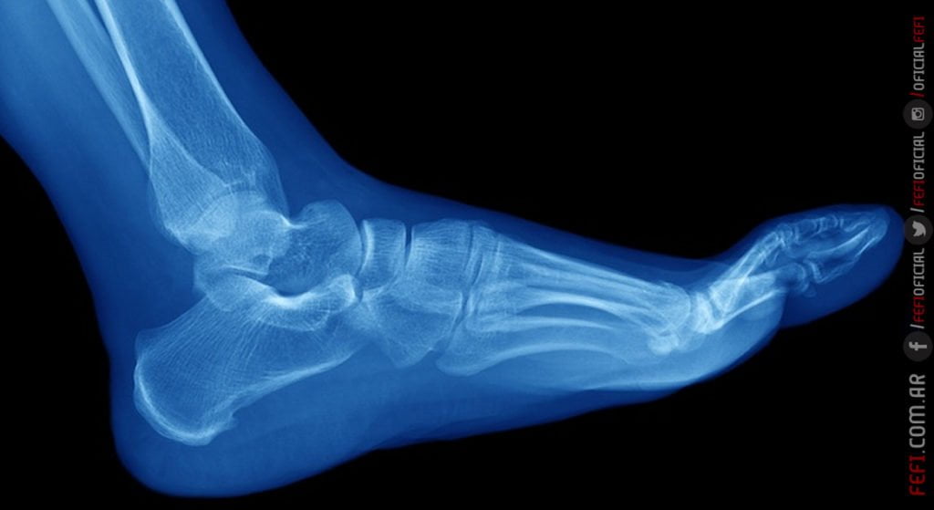 ¿Qué es la Entesitis y como tratarla? | FEFI